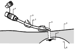 Sondevoeding via een PEG - ZorgSaam