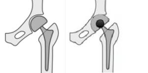 Heupfractuur (gebroken heup) - ZorgSaam