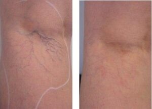 Spataders - ZorgSaam