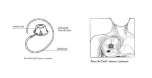 Port-a-Cath (PAC) - ZorgSaam